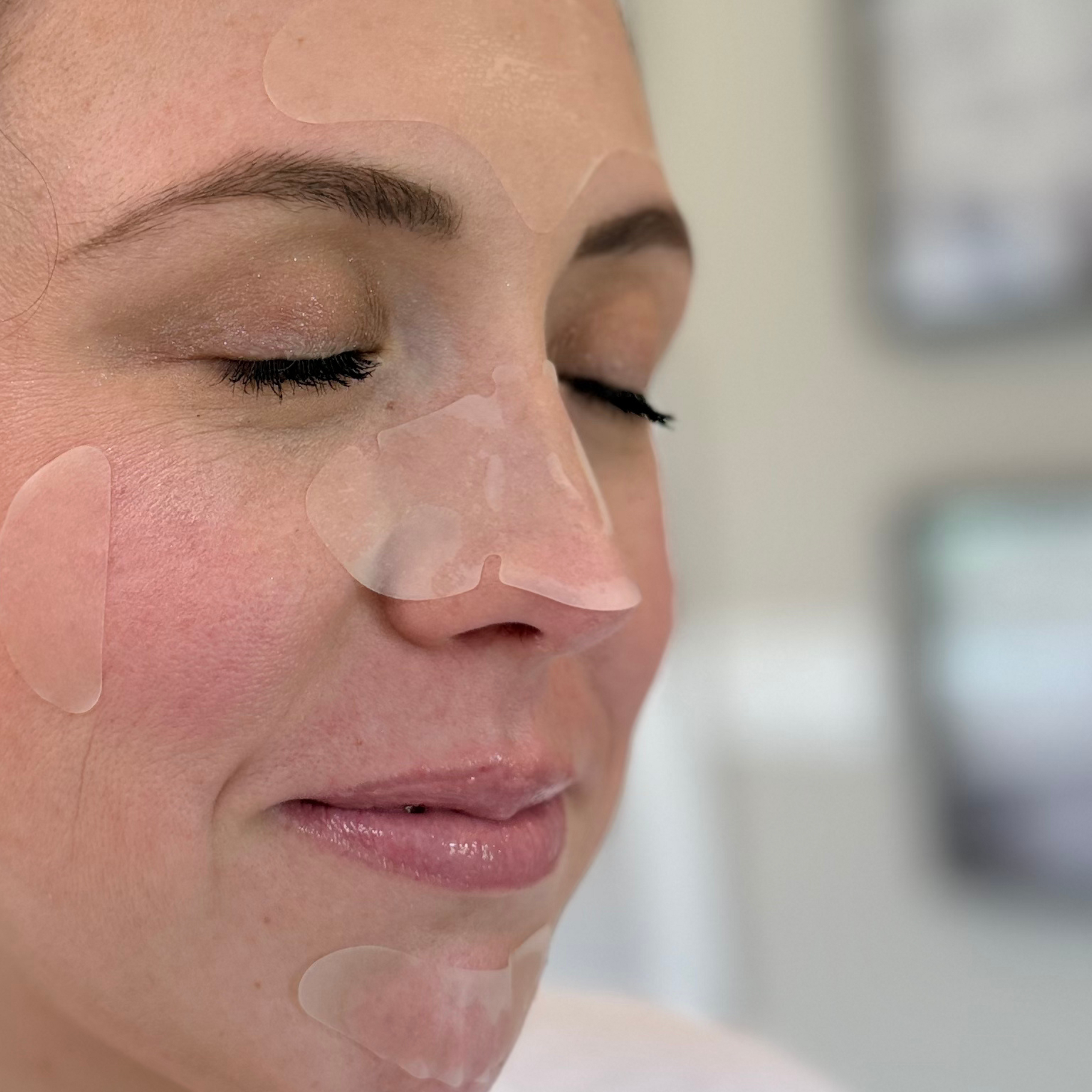 Pimple Patch Full Face – 15 Hydrocolloid Patches for Chin, Cheeks, Nos